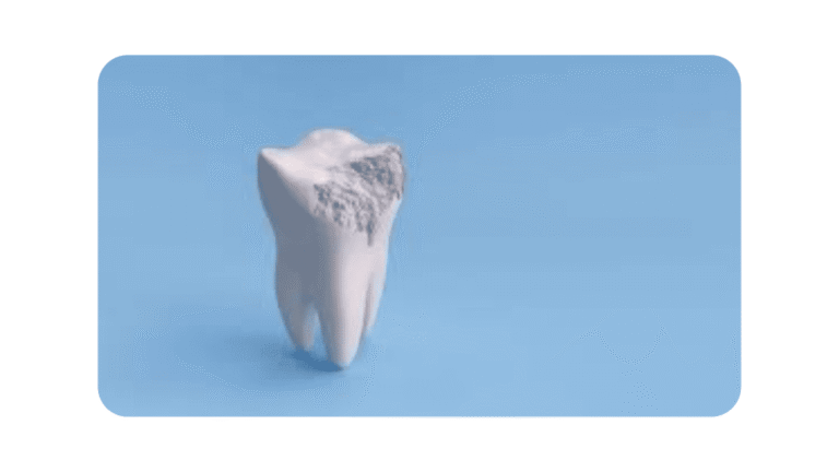 Tooth Enamel Erosion Treatment | Summerlin Dentist